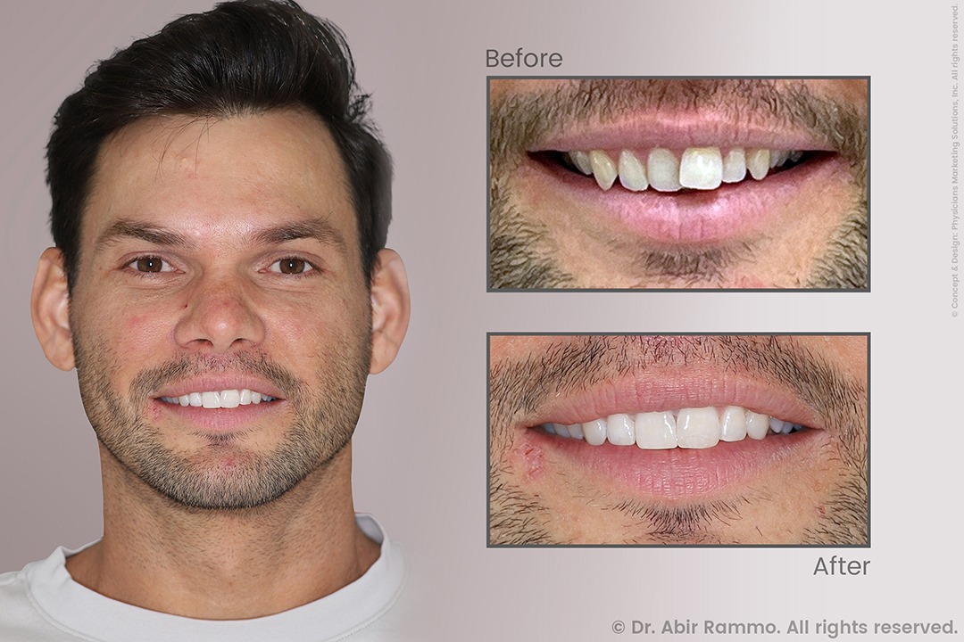 Misaligned and Overlapped Teeth - Family and Cosmetic Services in NSW | Dr Abir Rammo