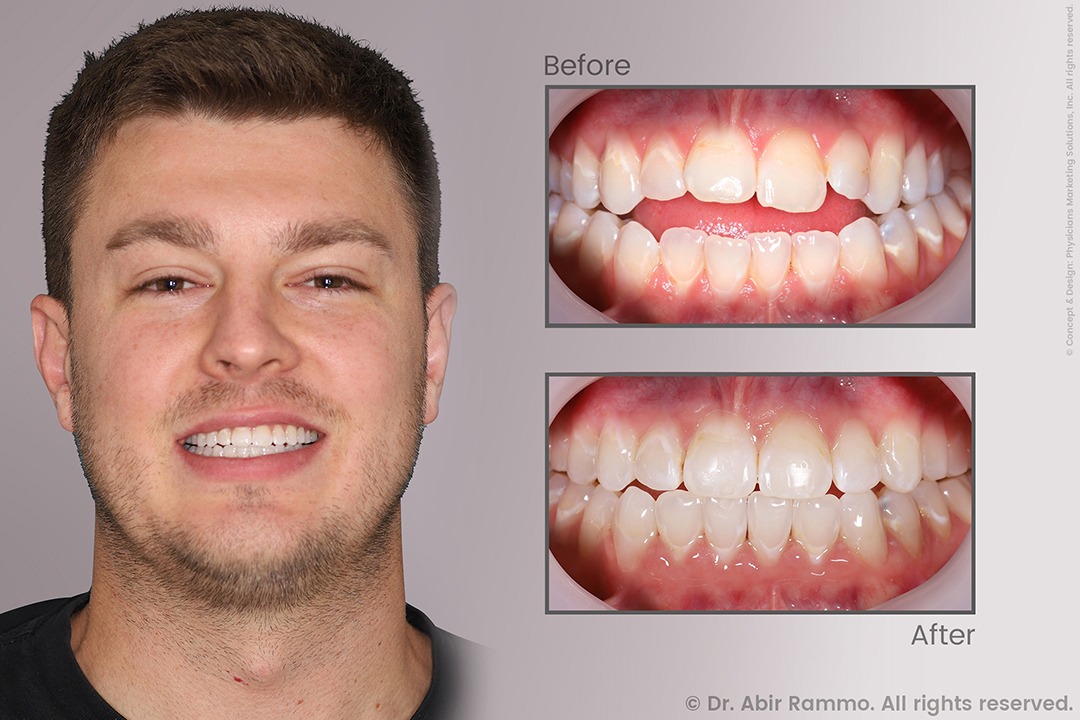 Invisalign and Whitening - Family and Cosmetic Services in NSW | Dr ...