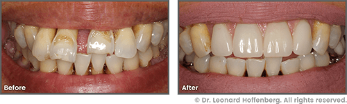 Loose and Uneven Teeth Treated with Partial Dentures